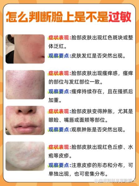 皮肤过敏症状图片_怎么判断是不是过敏-第1张图片-山城妙识 皮肤过敏症状图片_怎么判断是不是过敏-第1张图片-山城妙识