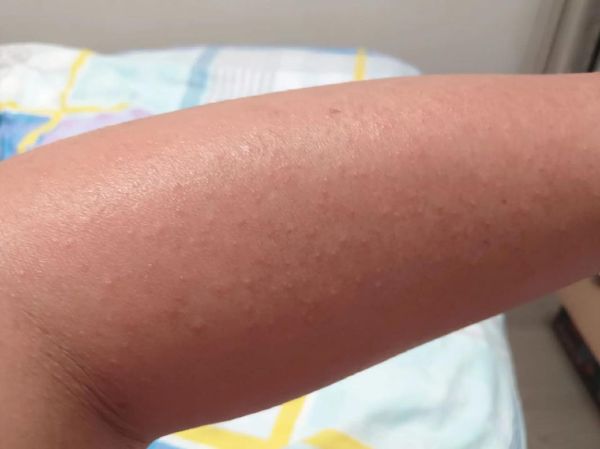 皮肤过敏症状图片_怎么判断是不是过敏-第3张图片-山城妙识 皮肤过敏症状图片_怎么判断是不是过敏-第3张图片-山城妙识