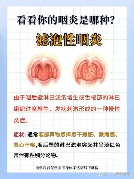 咽炎症状有哪些_慢性咽炎能自愈吗-第3张图片-山城妙识