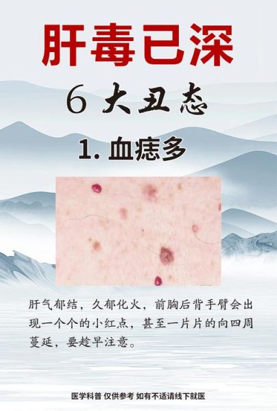 肝炎的早期症状有哪些_肝炎前兆会持续多久-第3张图片-山城妙识