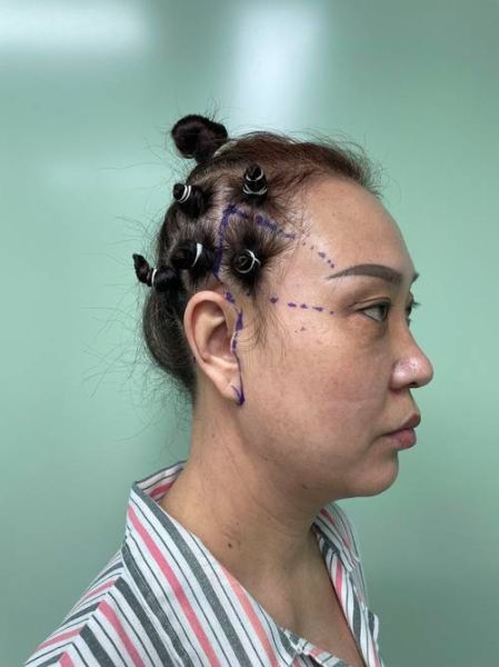 拉皮手术是怎么做的_拉皮手术全过程-第1张图片-山城妙识 拉皮手术是怎么做的_拉皮手术全过程-第1张图片-山城妙识