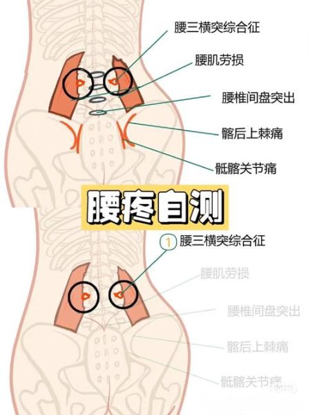 腰往下一点屁股上面那段疼是怎么回事_久坐腰疼屁股上方疼怎么缓解-第2张图片-山城妙识 腰往下一点屁股上面那段疼是怎么回事_久坐腰疼屁股上方疼怎么缓解-第2张图片-山城妙识