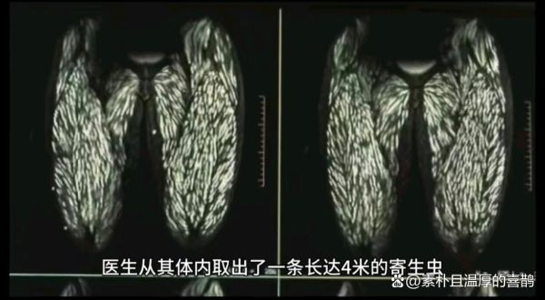 绦虫病症状_感染后多久出现-第1张图片-山城妙识