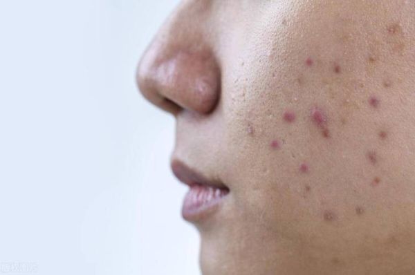 内分泌失调长痘怎么办_如何调理-第2张图片-山城妙识