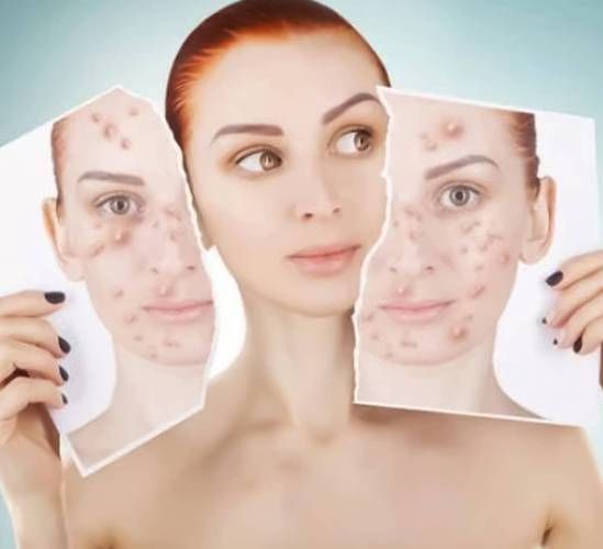 内分泌失调长痘怎么办_如何调理-第3张图片-山城妙识