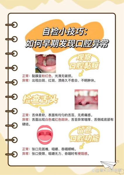 口腔溃疡反复不愈_警惕口腔癌前病变-第2张图片-山城妙识