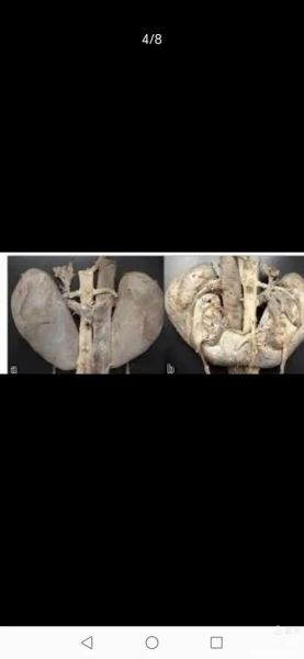 马蹄肾超声表现_马蹄肾超声能确诊吗-第1张图片-山城妙识