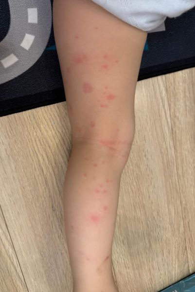 过敏性皮炎图片_怎么判断是不是过敏性皮炎-第1张图片-山城妙识