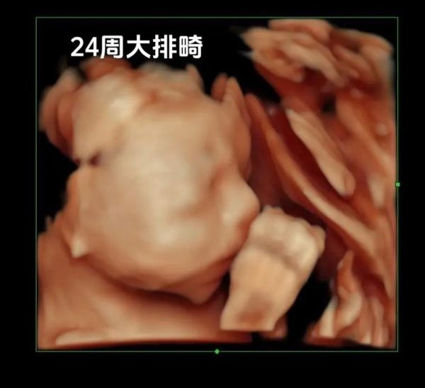 小排畸最佳时间_几周做最合适-第3张图片-山城妙识