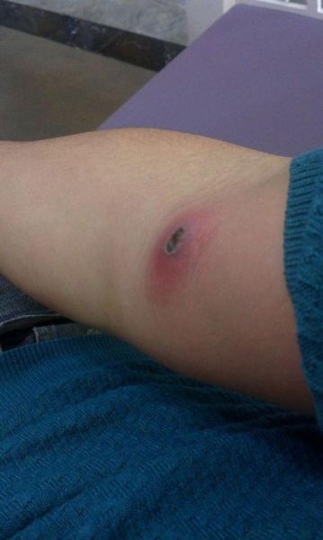 疖子没出脓有个硬疙瘩_多久能消-第1张图片-山城妙识 疖子没出脓有个硬疙瘩_多久能消-第1张图片-山城妙识