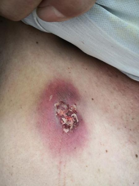 疖子没出脓有个硬疙瘩_多久能消-第2张图片-山城妙识 疖子没出脓有个硬疙瘩_多久能消-第2张图片-山城妙识