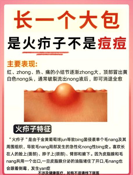 疖子没出脓有个硬疙瘩_多久能消-第3张图片-山城妙识 疖子没出脓有个硬疙瘩_多久能消-第3张图片-山城妙识