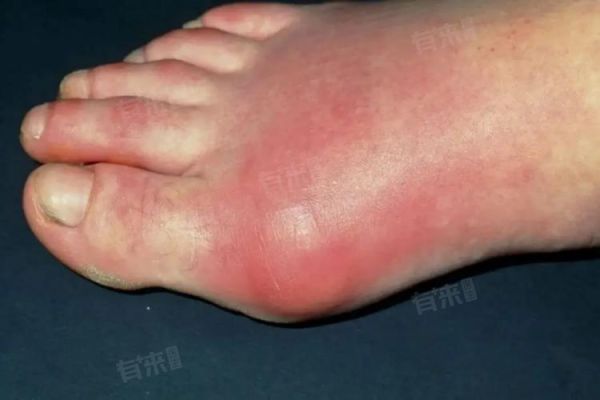 女性尿酸高的早期表现_尿酸高初期症状有哪些-第3张图片-山城妙识 女性尿酸高的早期表现_尿酸高初期症状有哪些-第3张图片-山城妙识