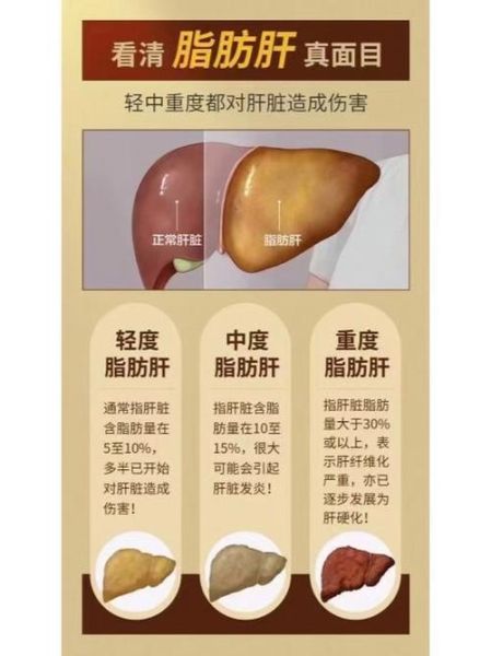 脂肪肝的症状有哪些_脂肪肝早期表现-第1张图片-山城妙识