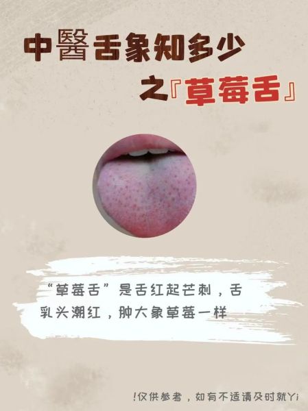草莓舌头图片_草莓舌头是什么原因-第1张图片-山城妙识 草莓舌头图片_草莓舌头是什么原因-第1张图片-山城妙识