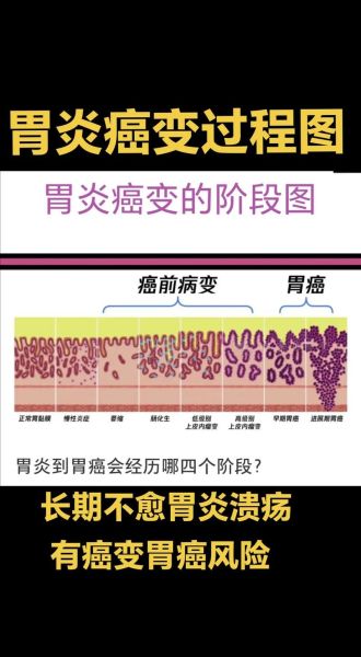 慢性胃炎多久会癌变_慢性胃炎癌变的几率有多大-第1张图片-山城妙识 慢性胃炎多久会癌变_慢性胃炎癌变的几率有多大-第1张图片-山城妙识