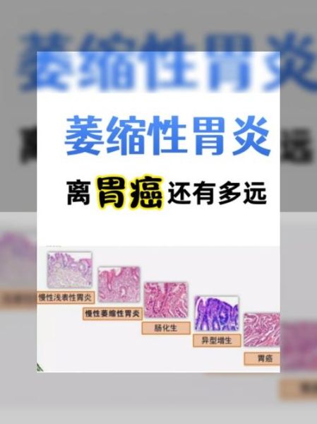 慢性胃炎多久会癌变_慢性胃炎癌变的几率有多大-第3张图片-山城妙识 慢性胃炎多久会癌变_慢性胃炎癌变的几率有多大-第3张图片-山城妙识