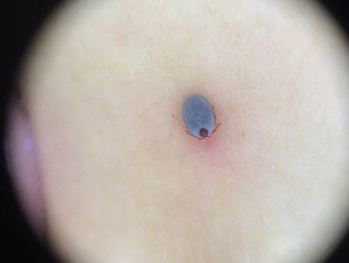 莲蓬乳皮肤病图片_怎么辨别真假-第3张图片-山城妙识