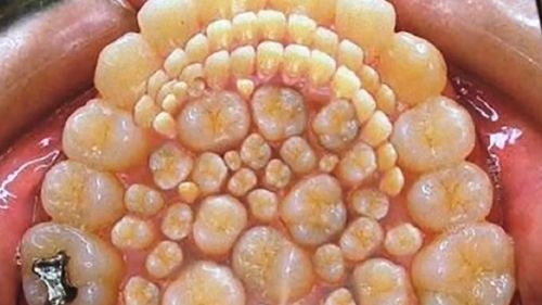 莲蓬乳皮肤病图片_怎么辨别真假-第1张图片-山城妙识