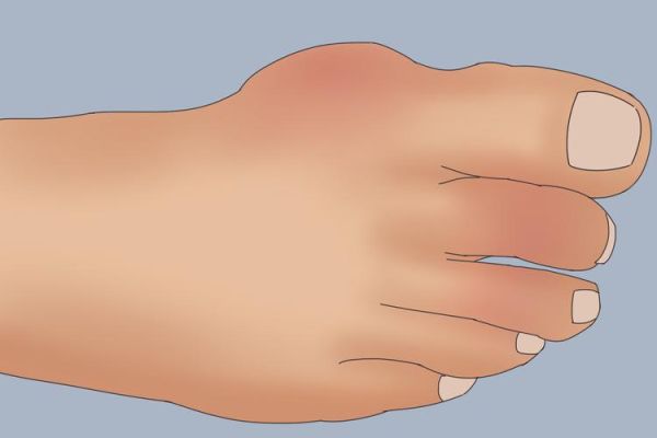 女人痛风先痛在哪里_女性痛风初期症状部位-第3张图片-山城妙识