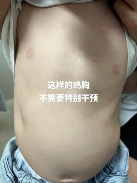 轻度鸡胸怎么办_轻度鸡胸需要治疗吗-第2张图片-山城妙识