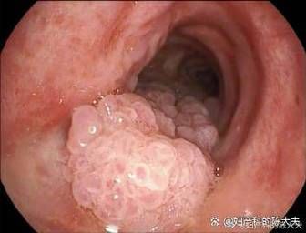 男性菜花病早期症状_男性菜花病怎么治疗-第1张图片-山城妙识 男性菜花病早期症状_男性菜花病怎么治疗-第1张图片-山城妙识