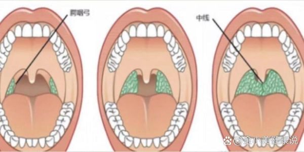 扁桃体肿大分度图解_一度二度三度怎么区分-第1张图片-山城妙识 扁桃体肿大分度图解_一度二度三度怎么区分-第1张图片-山城妙识
