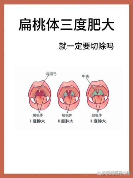扁桃体肿大分度图解_一度二度三度怎么区分-第2张图片-山城妙识 扁桃体肿大分度图解_一度二度三度怎么区分-第2张图片-山城妙识