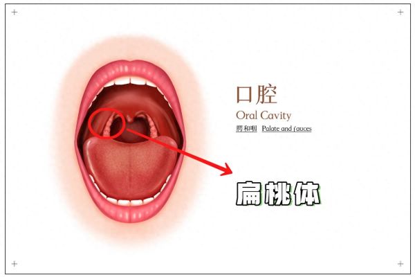 扁桃体肿大分度图解_一度二度三度怎么区分-第3张图片-山城妙识 扁桃体肿大分度图解_一度二度三度怎么区分-第3张图片-山城妙识