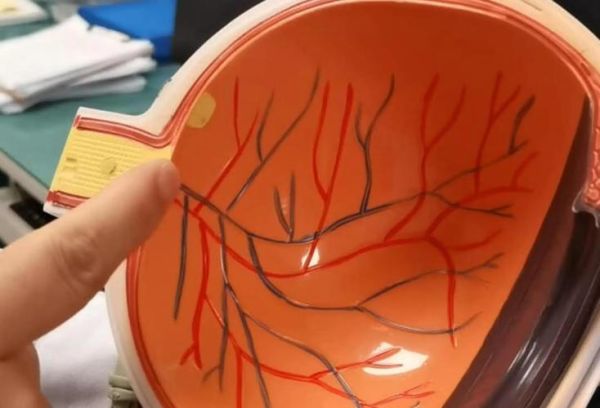 脉络膜是什么_脉络膜炎怎么治疗-第2张图片-山城妙识