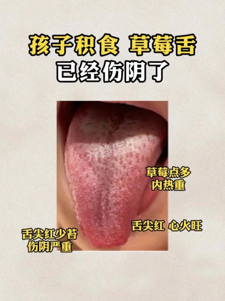 草莓舌苔是怎么回事_草莓舌苔是病吗-第3张图片-山城妙识