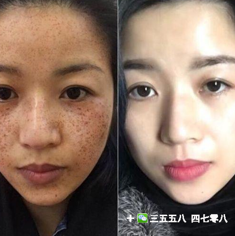 内分泌失调脸上长斑怎么调_吃什么药-第3张图片-山城妙识