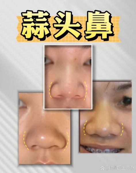 大蒜鼻子大怎样变小_大蒜鼻子缩小方法-第2张图片-山城妙识 大蒜鼻子大怎样变小_大蒜鼻子缩小方法-第2张图片-山城妙识