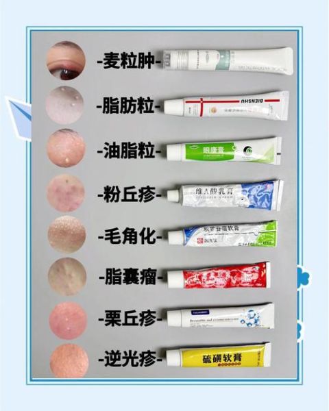 脂肪粒怎么去除_脂肪粒用什么药膏-第1张图片-山城妙识