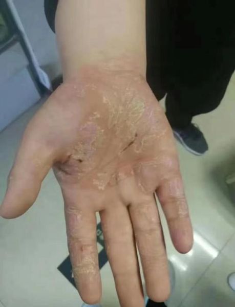 鹅掌风手干裂怎么治疗_手癣干裂最快恢复方法-第1张图片-山城妙识 鹅掌风手干裂怎么治疗_手癣干裂最快恢复方法-第1张图片-山城妙识