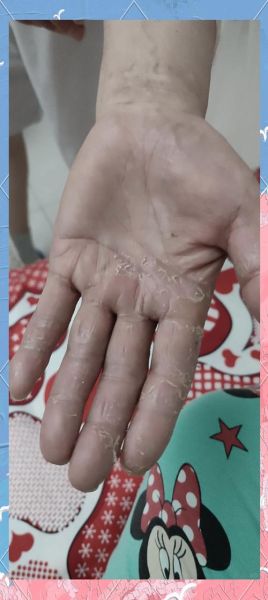 鹅掌风手干裂怎么治疗_手癣干裂最快恢复方法-第2张图片-山城妙识 鹅掌风手干裂怎么治疗_手癣干裂最快恢复方法-第2张图片-山城妙识