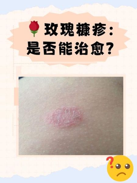 玫瑰糠疹传染吗_玫瑰糠疹会传染给家人吗-第1张图片-山城妙识 玫瑰糠疹传染吗_玫瑰糠疹会传染给家人吗-第1张图片-山城妙识