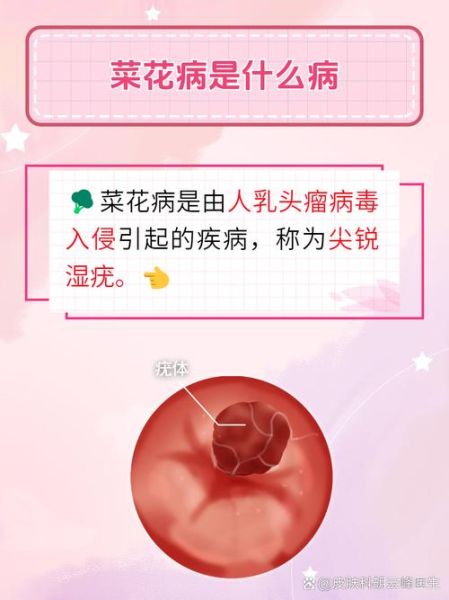 花菜病害有哪些_花菜病害防治方法-第2张图片-山城妙识 花菜病害有哪些_花菜病害防治方法-第2张图片-山城妙识