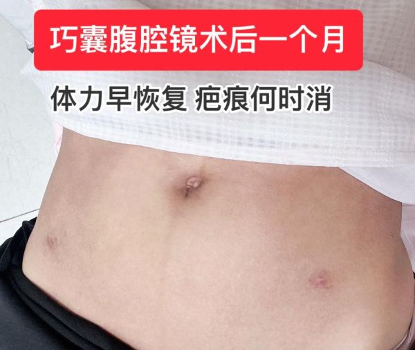 巧克力囊肿手术过程_术后多久恢复-第2张图片-山城妙识 巧克力囊肿手术过程_术后多久恢复-第2张图片-山城妙识