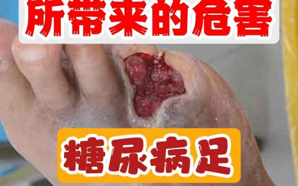 高血糖的早期症状有哪些_高血糖有哪些典型表现-第3张图片-山城妙识