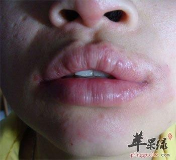 吃芒果嘴唇过敏怎么办_小妙招快速止痒-第3张图片-山城妙识