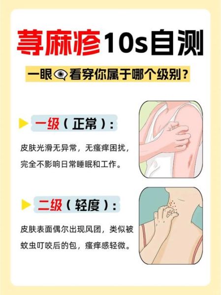 过敏症状图片怎么看_如何快速识别-第2张图片-山城妙识
