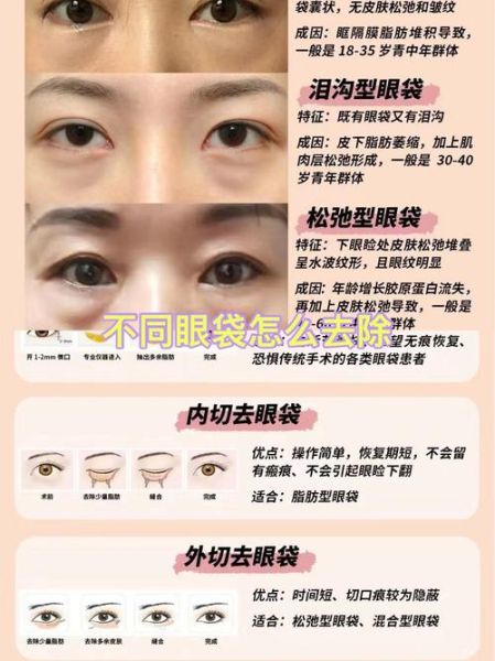 去眼袋最有效的土方法_眼袋怎么消除最快-第3张图片-山城妙识 去眼袋最有效的土方法_眼袋怎么消除最快-第3张图片-山城妙识