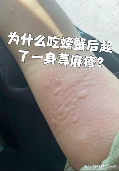 吃螃蟹过敏是什么原因_吃螃蟹过敏怎么办-第1张图片-山城妙识