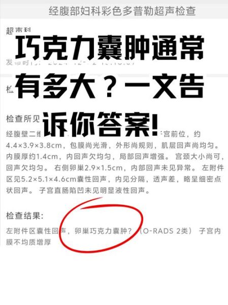 巧克力囊肿是恶性的还是良性的_巧克力囊肿会癌变吗-第2张图片-山城妙识