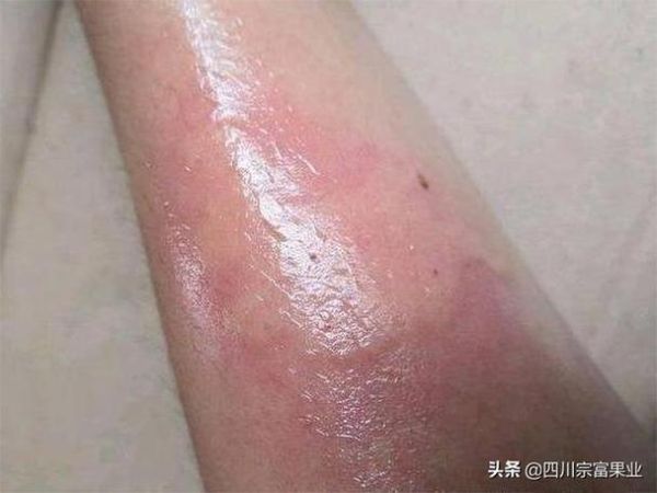 八角丁虫扎人后怎么办_八角丁虫毒刺怎么拔出-第1张图片-山城妙识 八角丁虫扎人后怎么办_八角丁虫毒刺怎么拔出-第1张图片-山城妙识