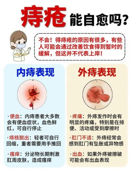 外痔疮怎么快速自愈_外痔疮多久能好-第1张图片-山城妙识