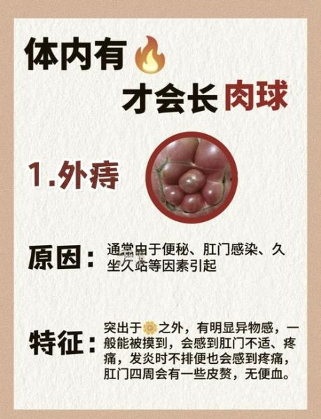 外痔疮怎么快速自愈_外痔疮多久能好-第2张图片-山城妙识