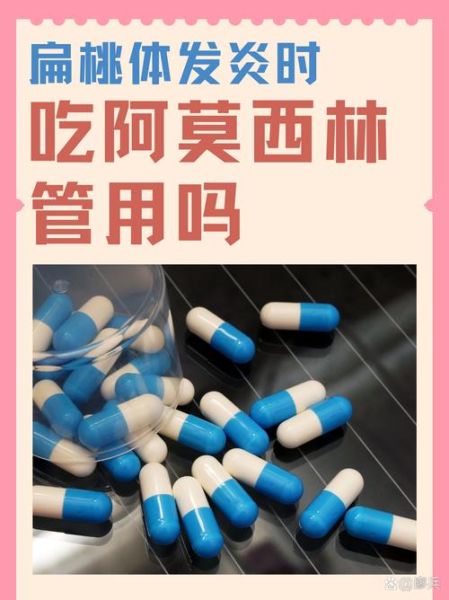 扁桃体发炎吃什么药好得快_扁桃体发炎用什么药见效快-第3张图片-山城妙识 扁桃体发炎吃什么药好得快_扁桃体发炎用什么药见效快-第3张图片-山城妙识