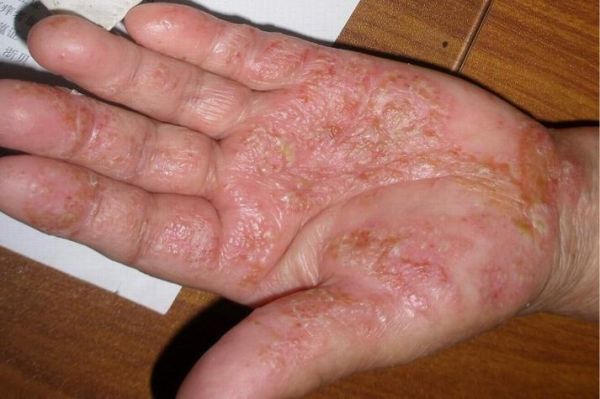 鹅掌癣初期症状图片_鹅掌癣会传染吗-第1张图片-山城妙识